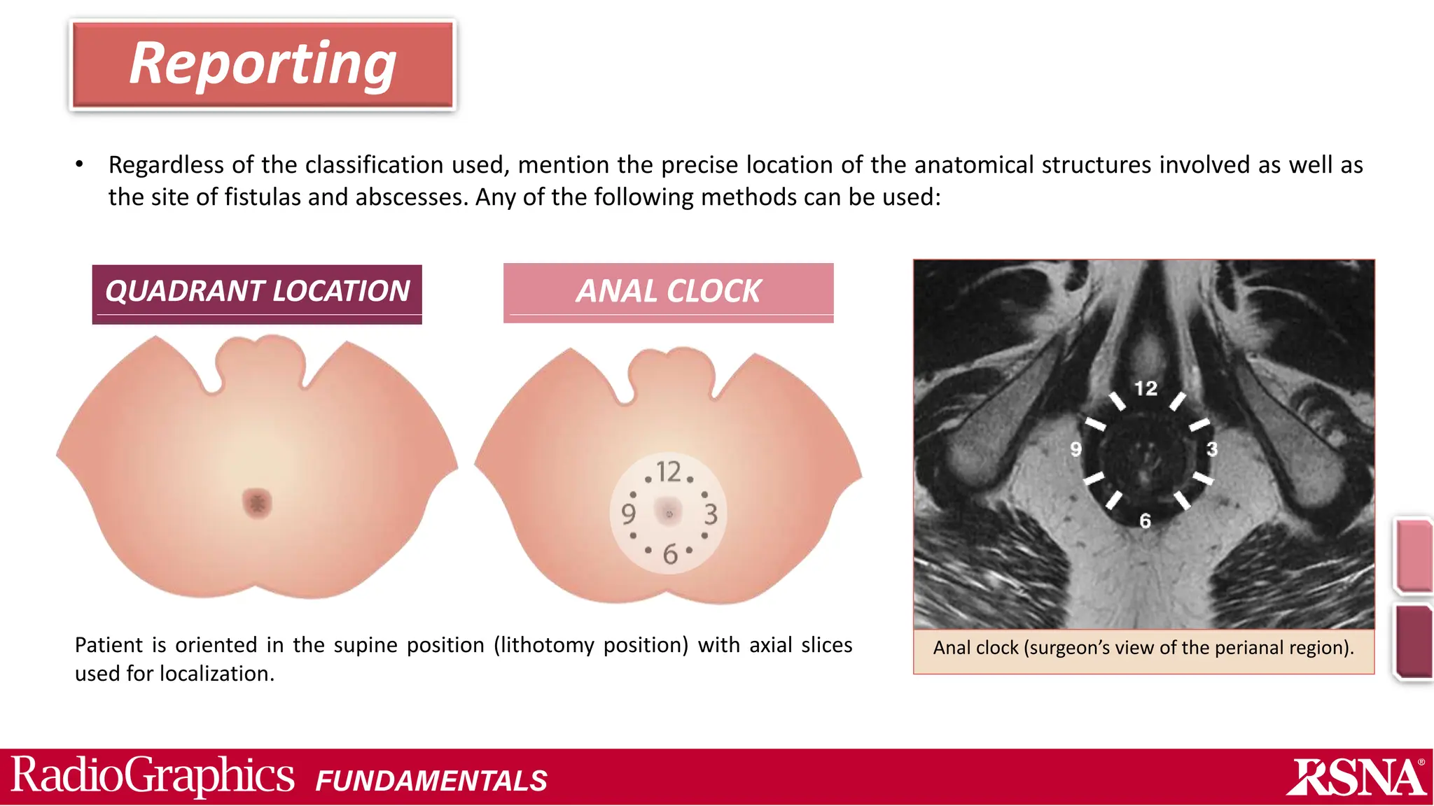 Perianal fistula and Abscess.pptx