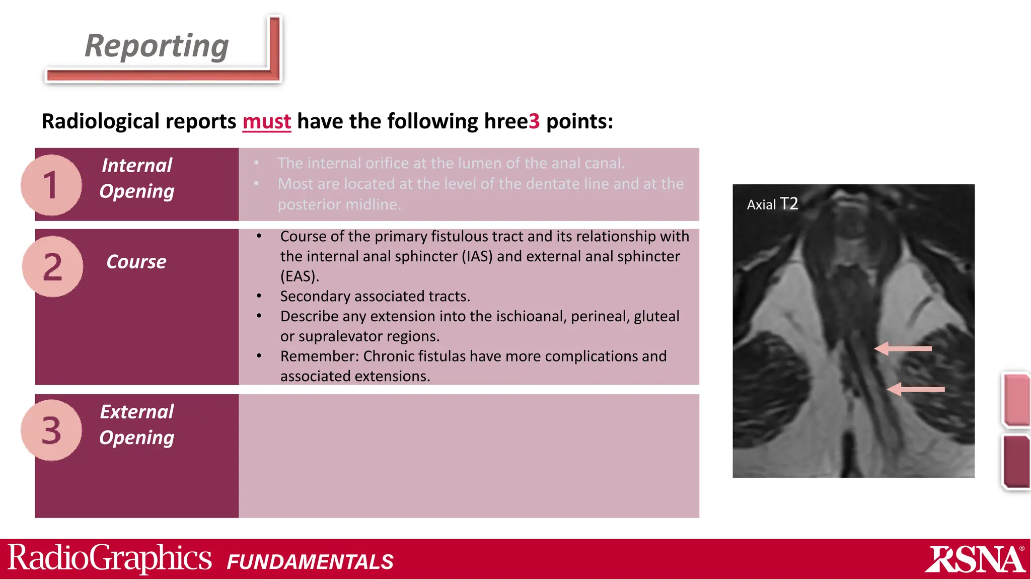 Perianal fistula and Abscess.pptx