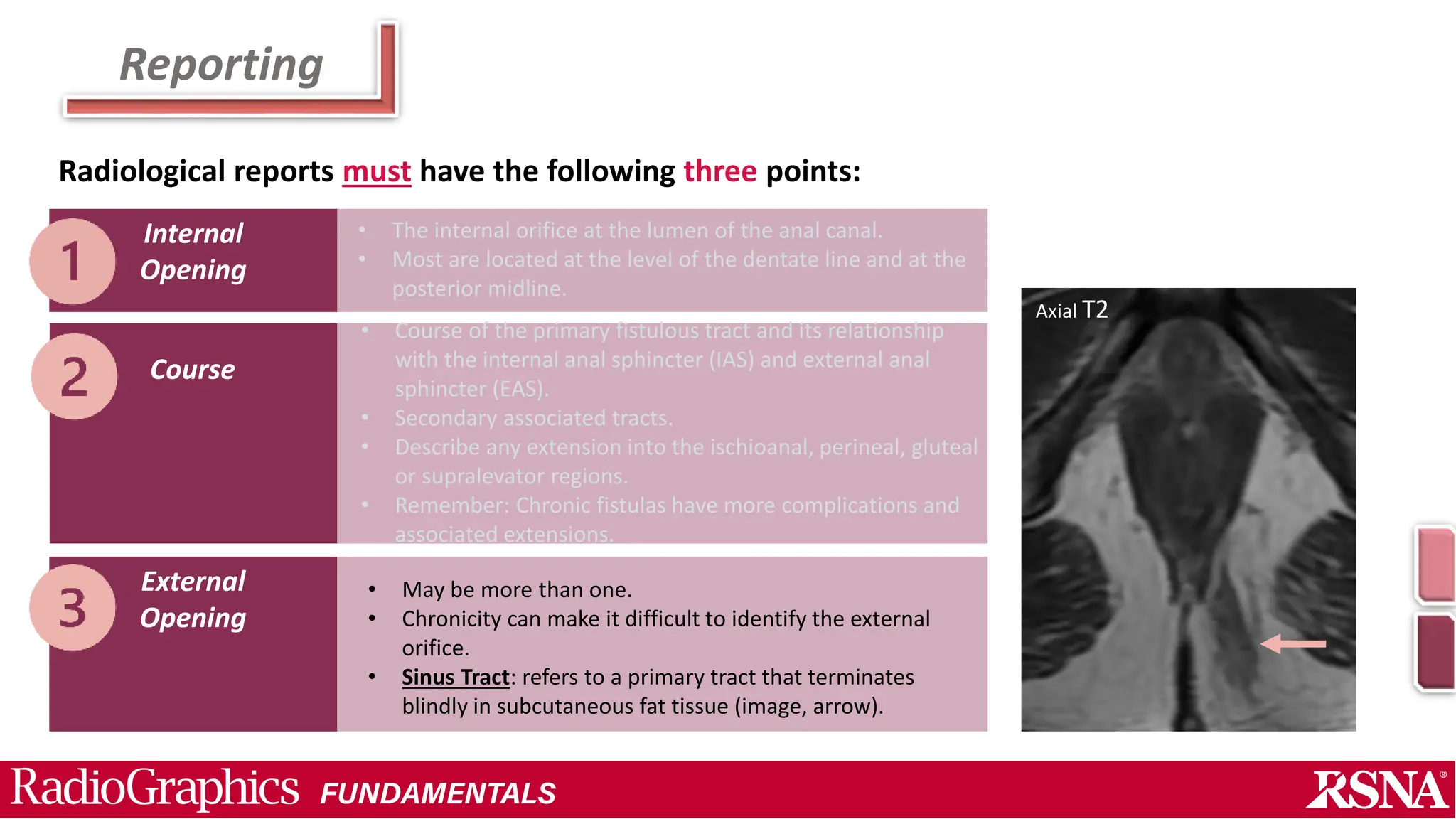 Perianal fistula and Abscess.pptx