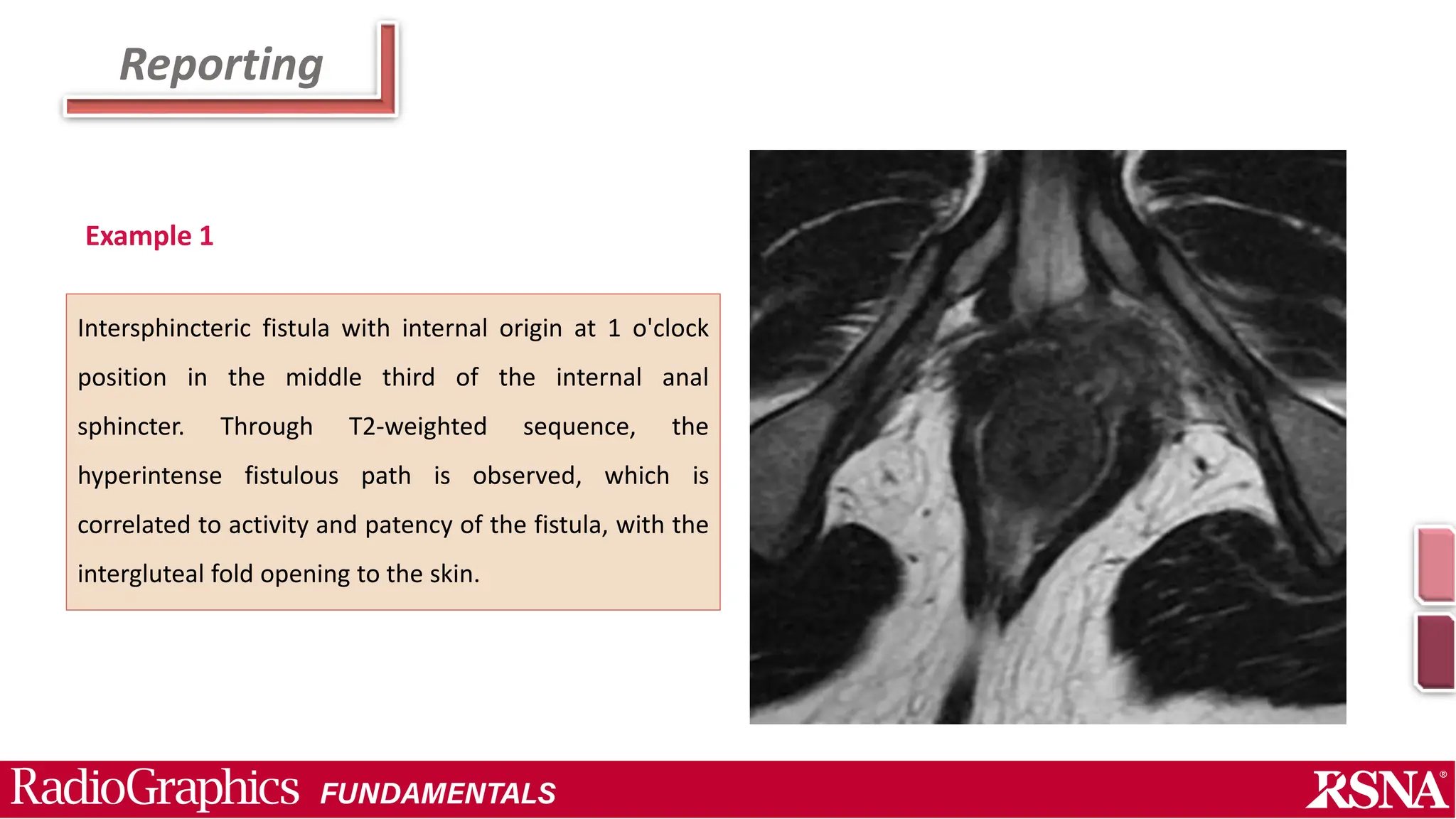 Perianal fistula and Abscess.pptx
