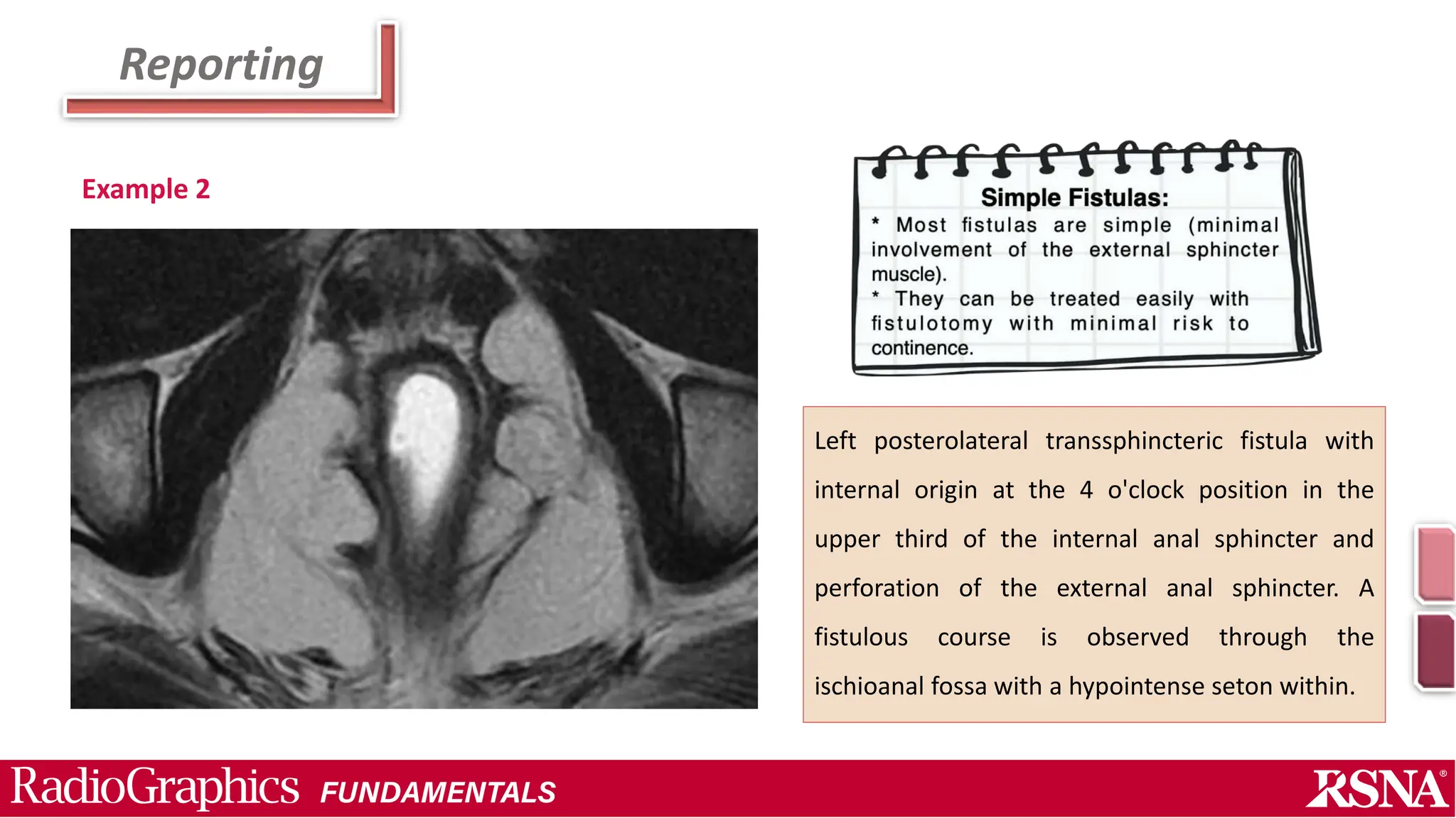 Perianal fistula and Abscess.pptx