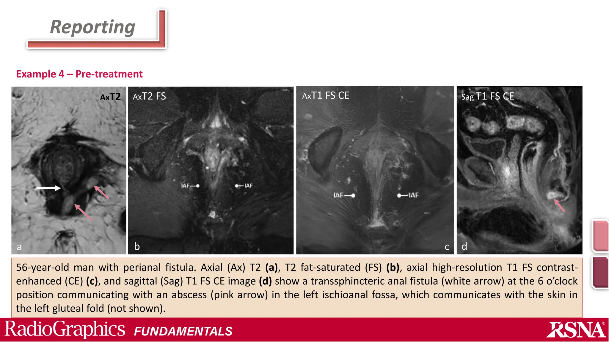 Perianal fistula and Abscess.pptx