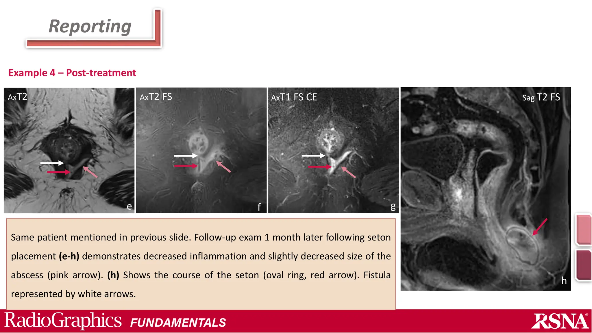 Perianal fistula and Abscess.pptx