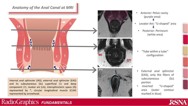 Perianal fistula and Abscess.pptx | Digestive Disorders | Diseases and ...