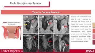 Perianal fistula and Abscess.pptx