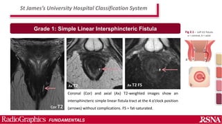 Perianal fistula and Abscess.pptx