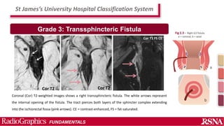 Perianal fistula and Abscess.pptx