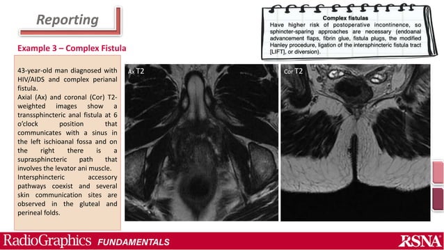 Perianal fistula and Abscess.pptx | Digestive Disorders | Diseases and ...
