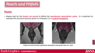 Perianal fistula and Abscess.pptx