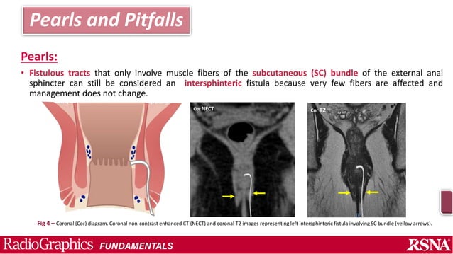 Perianal fistula and Abscess.pptx | Digestive Disorders | Diseases and ...