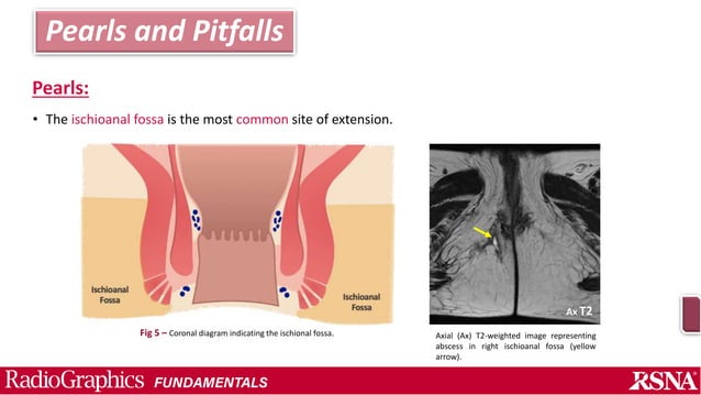 Perianal fistula and Abscess.pptx | Digestive Disorders | Diseases and ...