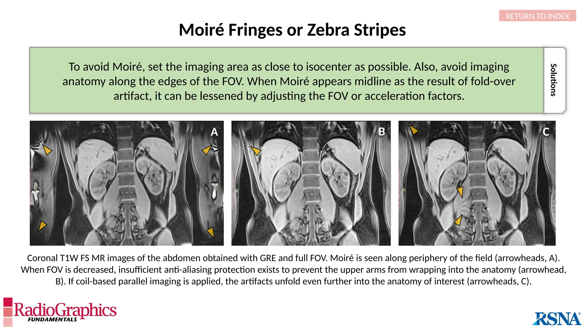 A primer on magnetic resonance imaging artifacts | PPTX