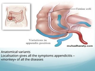 appendicitis acute n chronic . | PPTX