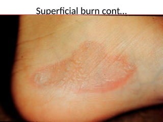 Pediatric burn is the leading cause of death in children - | PPT