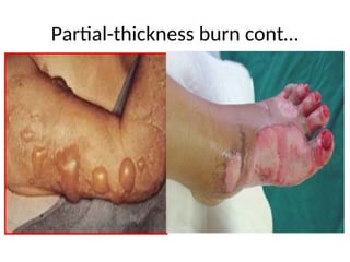 Pediatric burn is the leading cause of death in children - | PPT