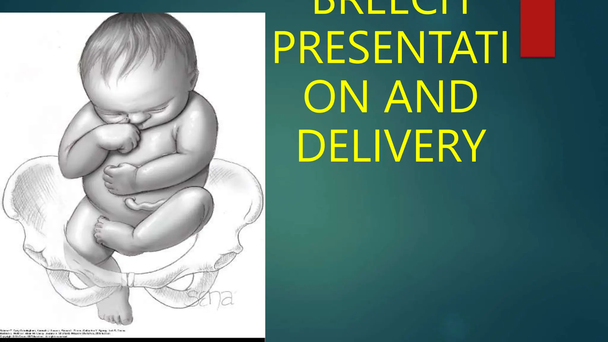 Breech presentation and child delivery pptx | PPTX