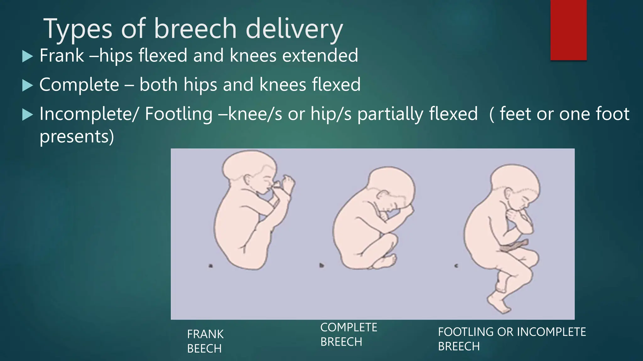 Breech presentation and child delivery pptx | PPTX
