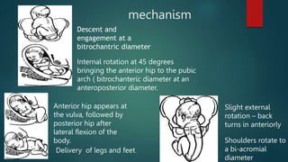 Breech presentation and child delivery pptx | PPTX
