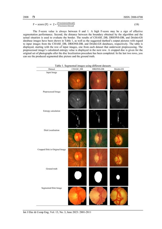 Segmentation of optic disc in retinal images for glaucoma diagnosis by saliency level set with ...