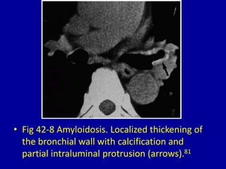 42 broncholithiasis | PPTX