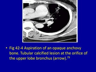 42 broncholithiasis | PPTX