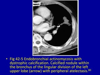 42 broncholithiasis | PPTX