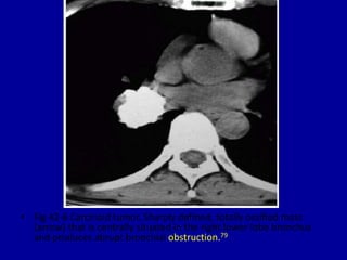 42 broncholithiasis | PPTX