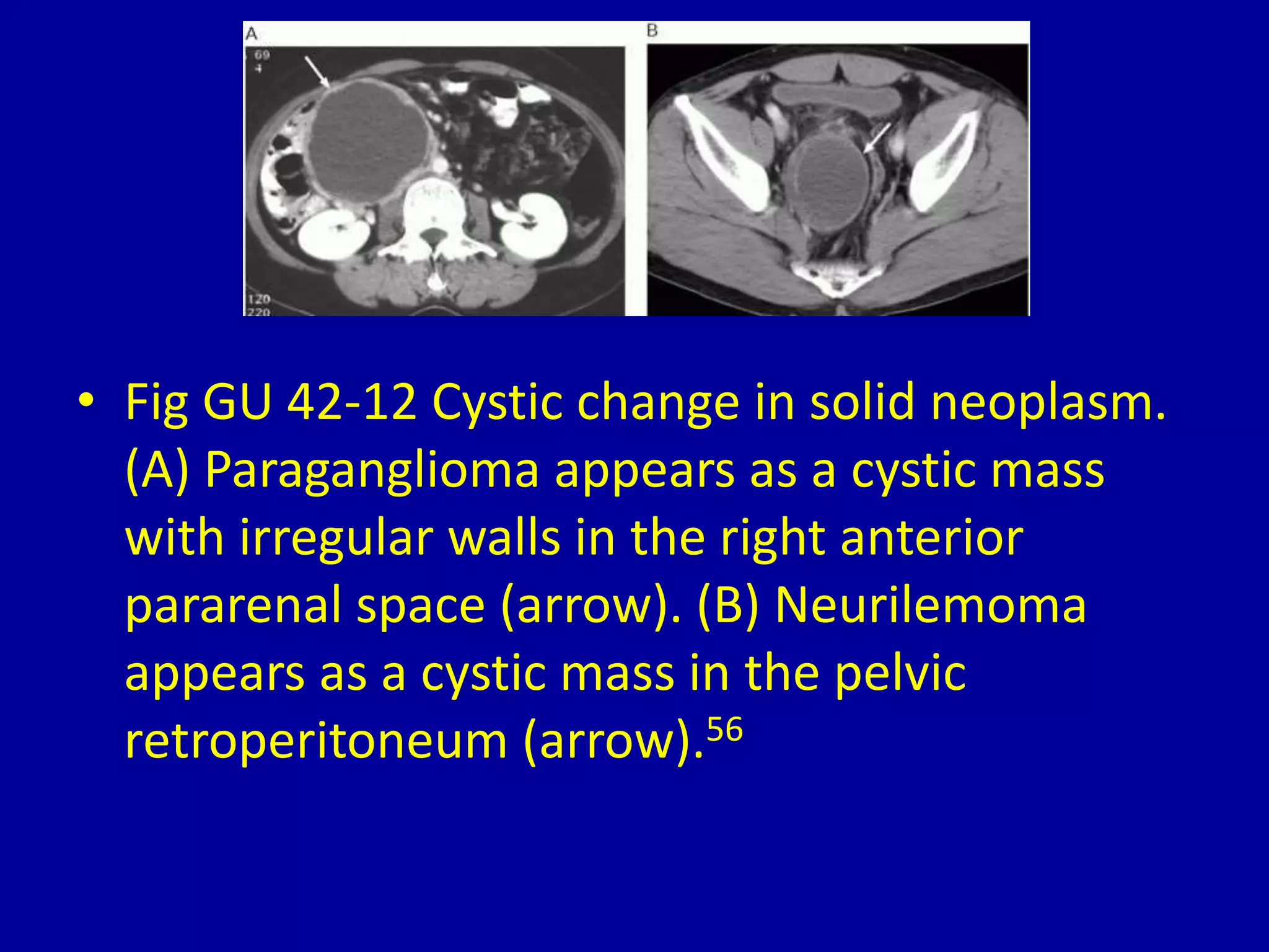 42 cystic retroperitoneal mass | PPTX