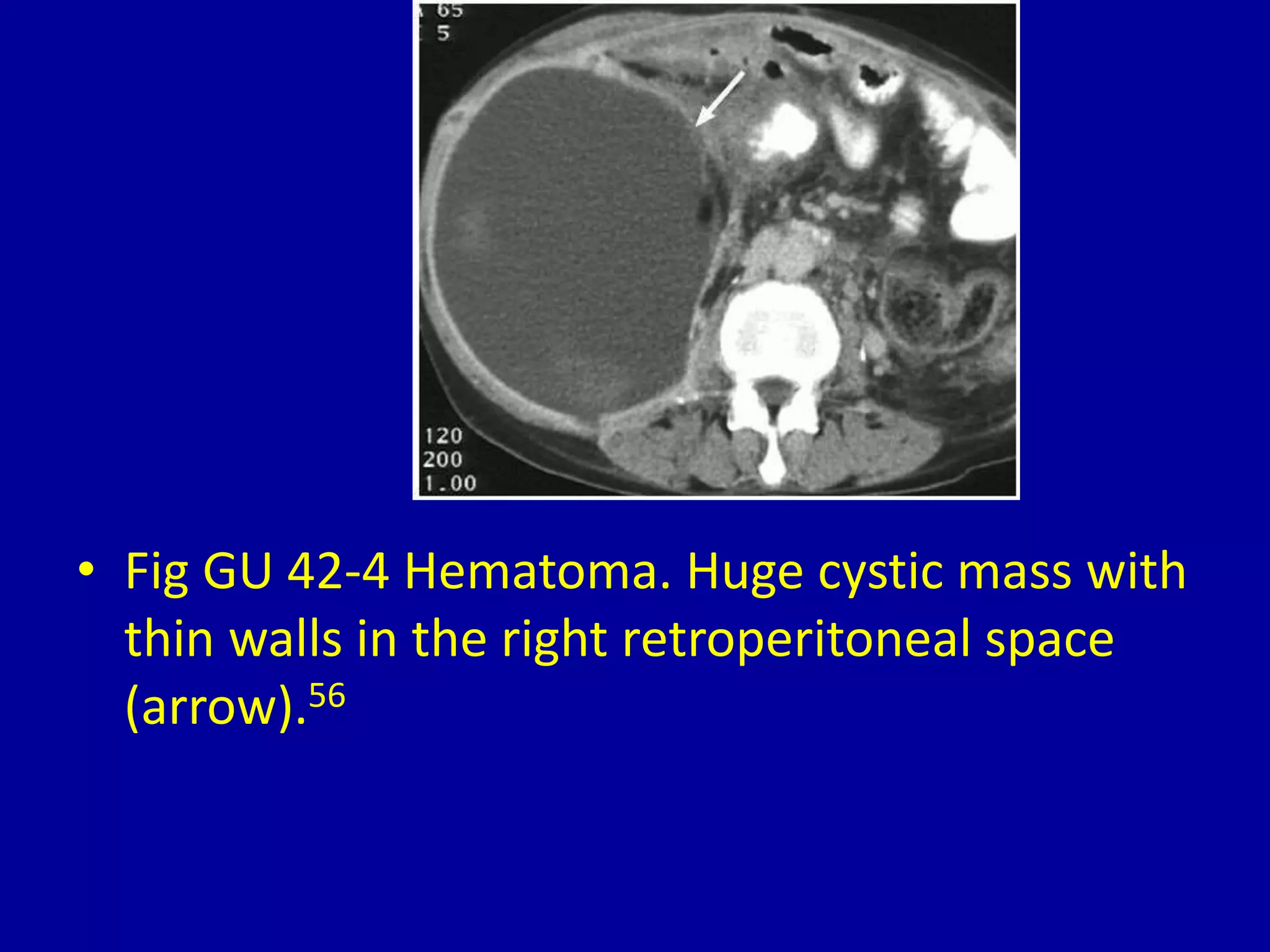 42 cystic retroperitoneal mass | PPTX