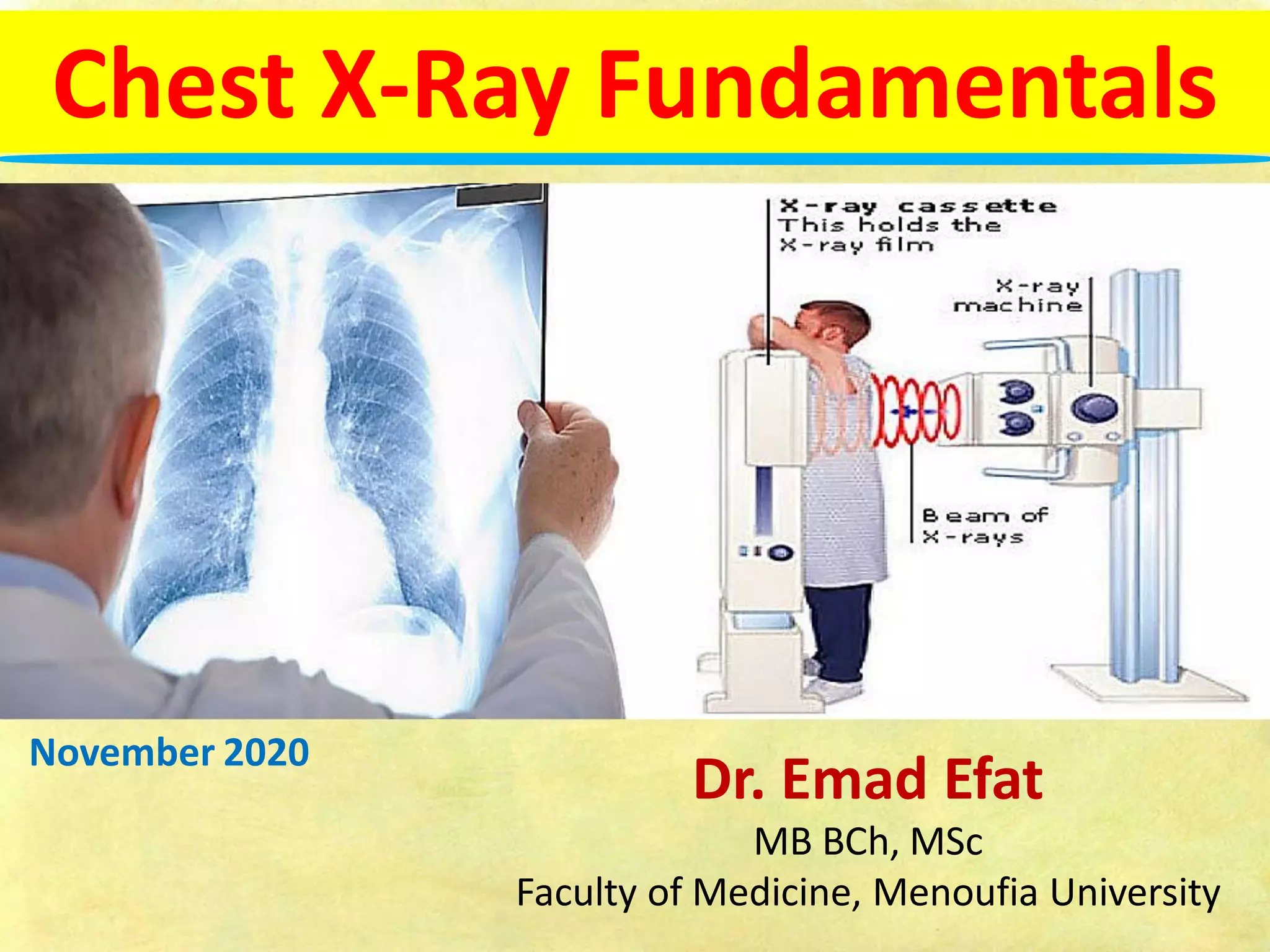 Chest x ray-fundamentals | PDF | Lung and Respiratory Health | Diseases ...