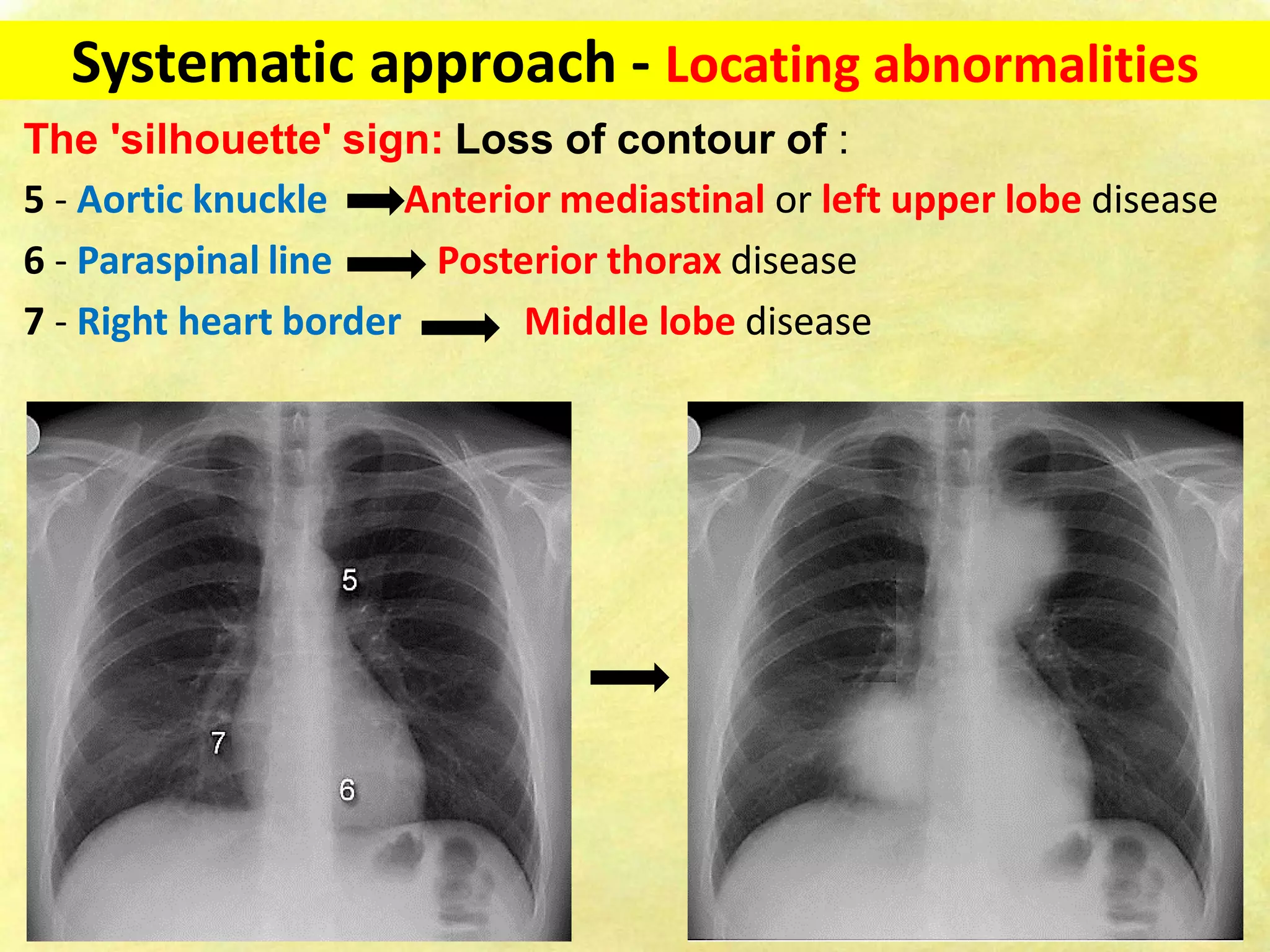 Chest x ray-fundamentals | PDF