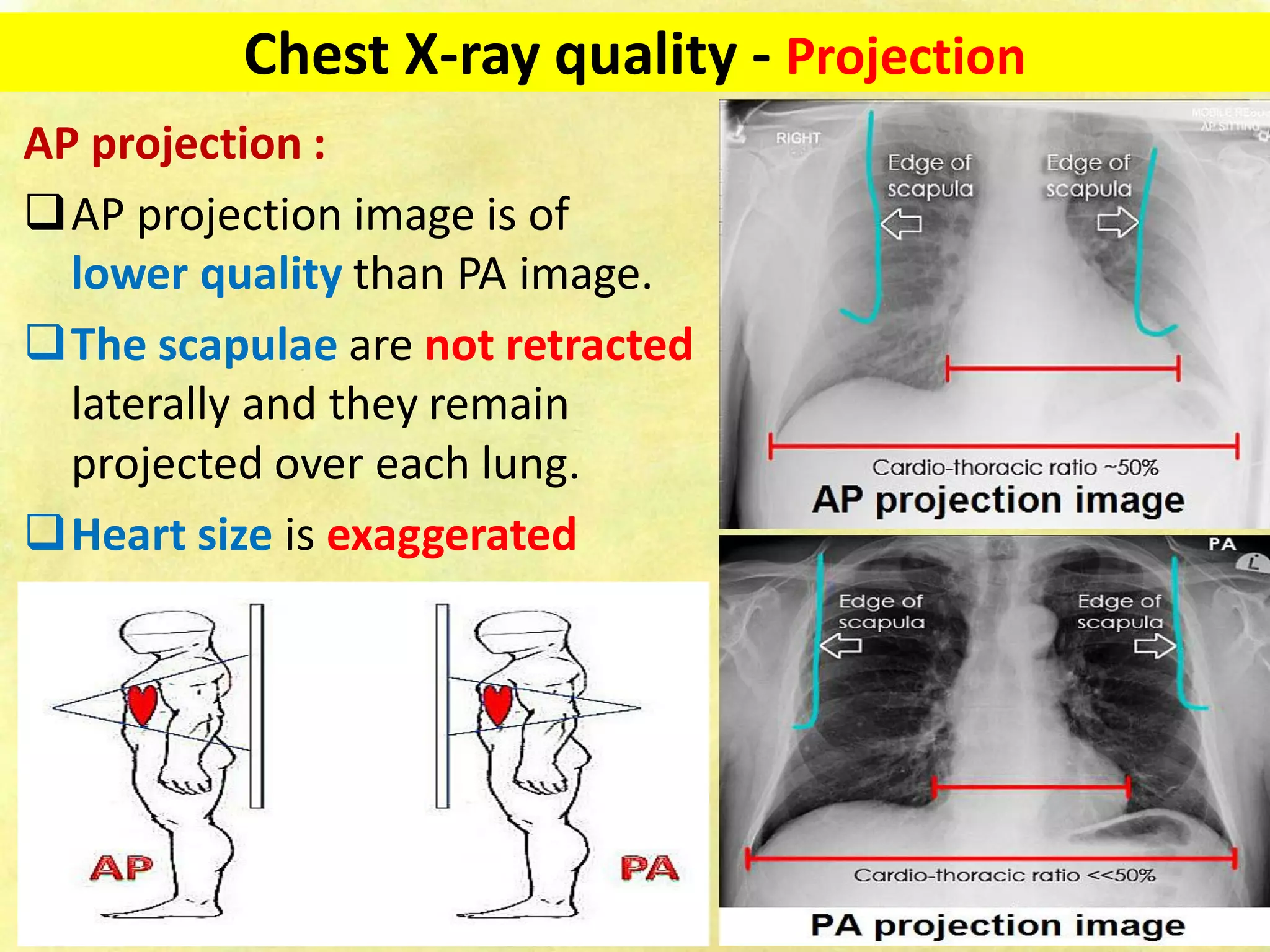 Chest x ray-fundamentals | PDF