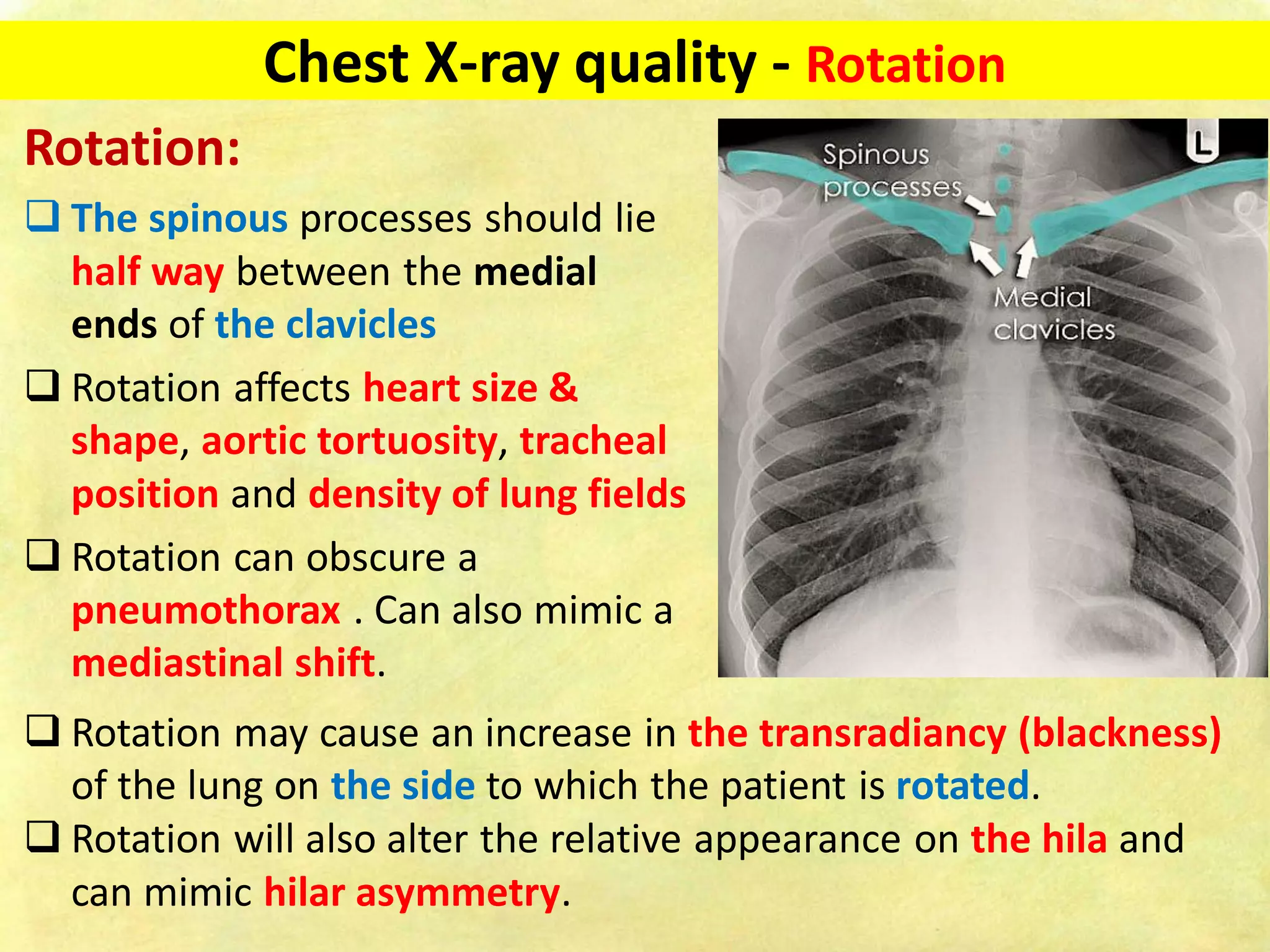 Chest x ray-fundamentals | PDF