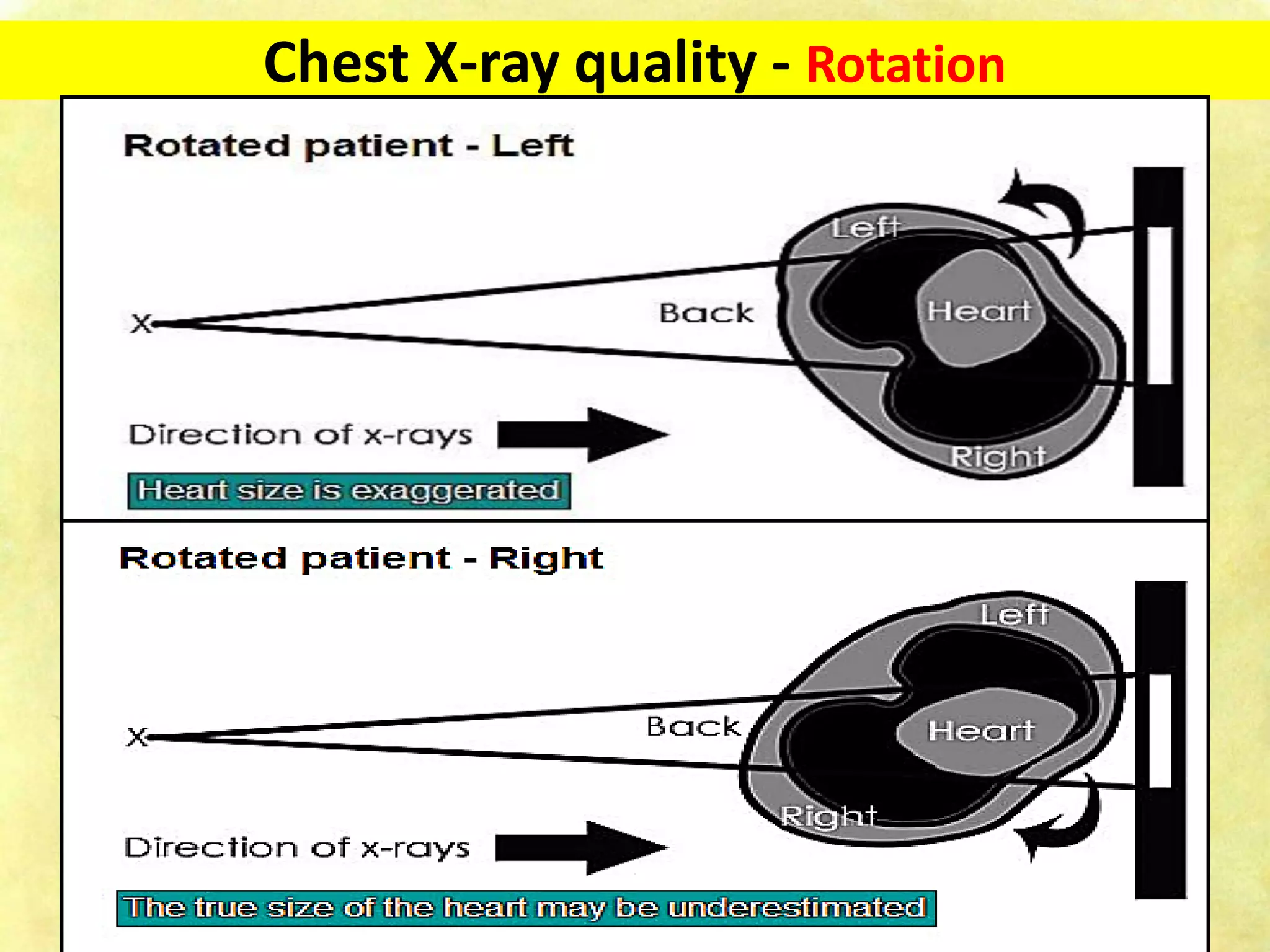 Chest x ray-fundamentals | PDF