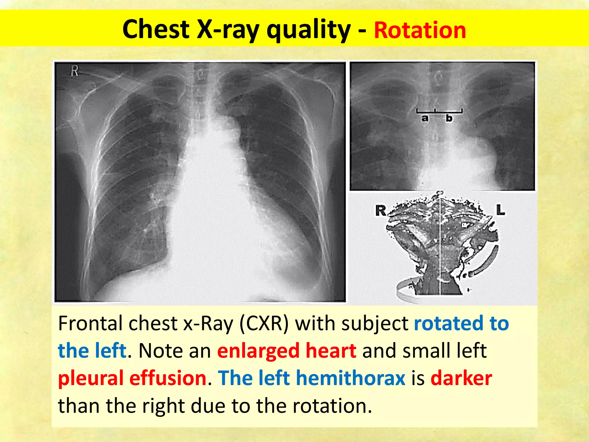 Chest x ray-fundamentals | PDF