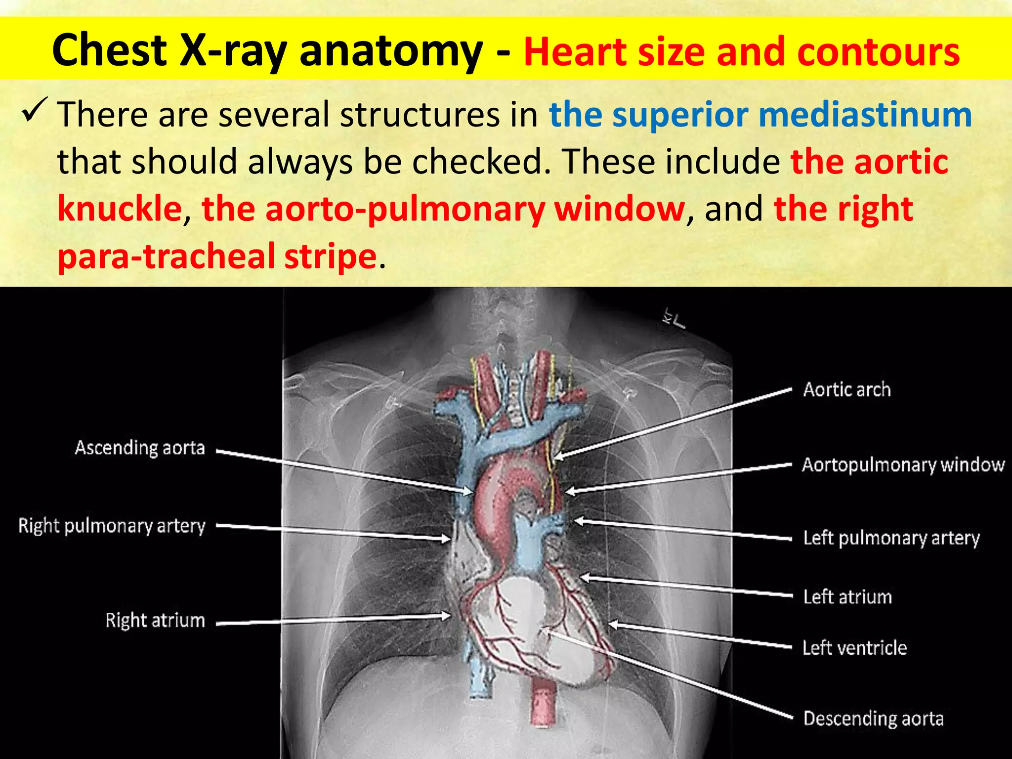 Chest x ray-fundamentals | PDF