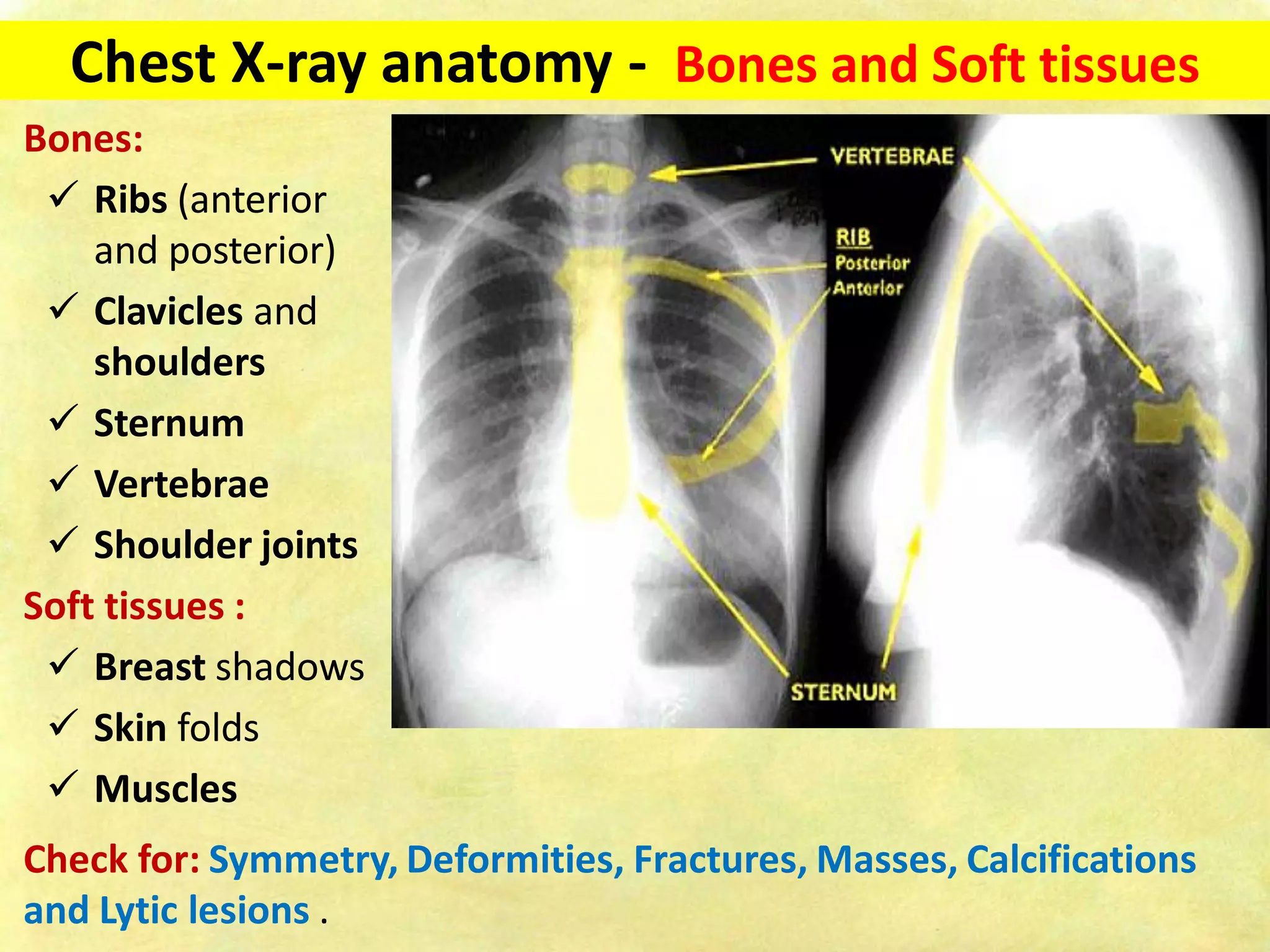 Chest x ray-fundamentals | PDF