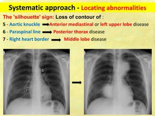 Chest x ray-fundamentals | PDF