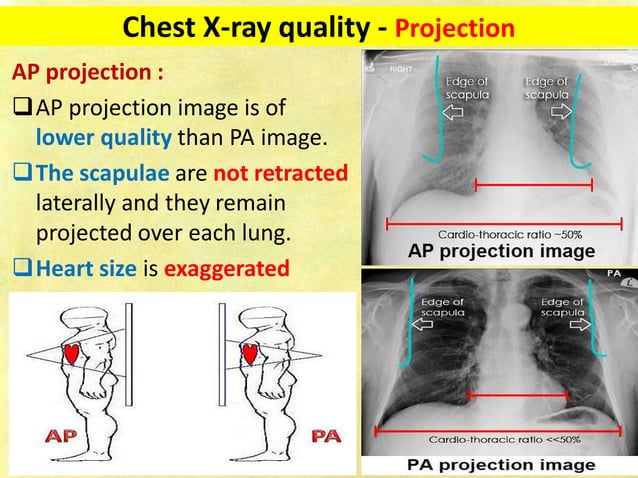 Chest x ray-fundamentals | PDF | Lung and Respiratory Health | Diseases ...