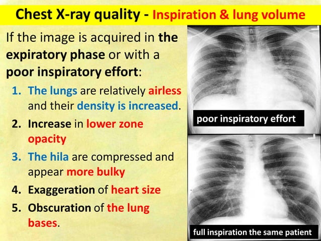 Chest x ray-fundamentals | PDF | Lung and Respiratory Health | Diseases ...