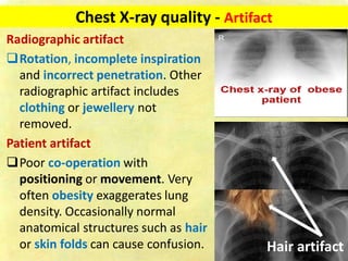Chest x ray-fundamentals | PDF