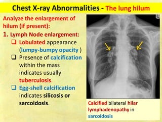 Chest x ray-fundamentals | PDF
