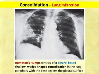 Chest x ray-fundamentals | PDF