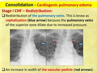 Chest x ray-fundamentals | PDF