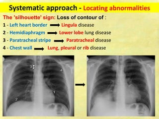 Outlines Of Lung On Cxr
