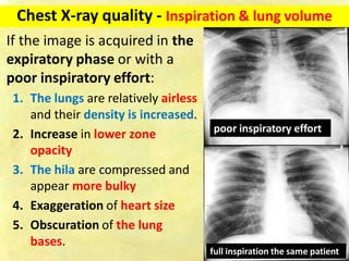 Chest x ray-fundamentals | PPT
