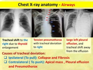 Tracheal Deviation X Ray
