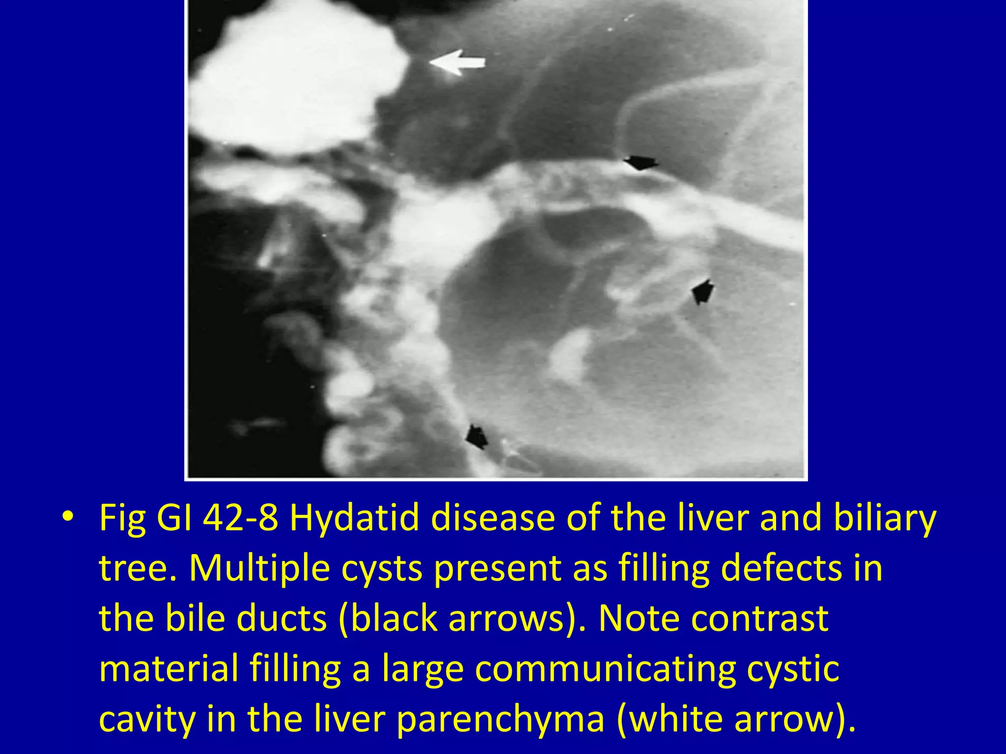 42 filling defects in the bile ducts | PPT