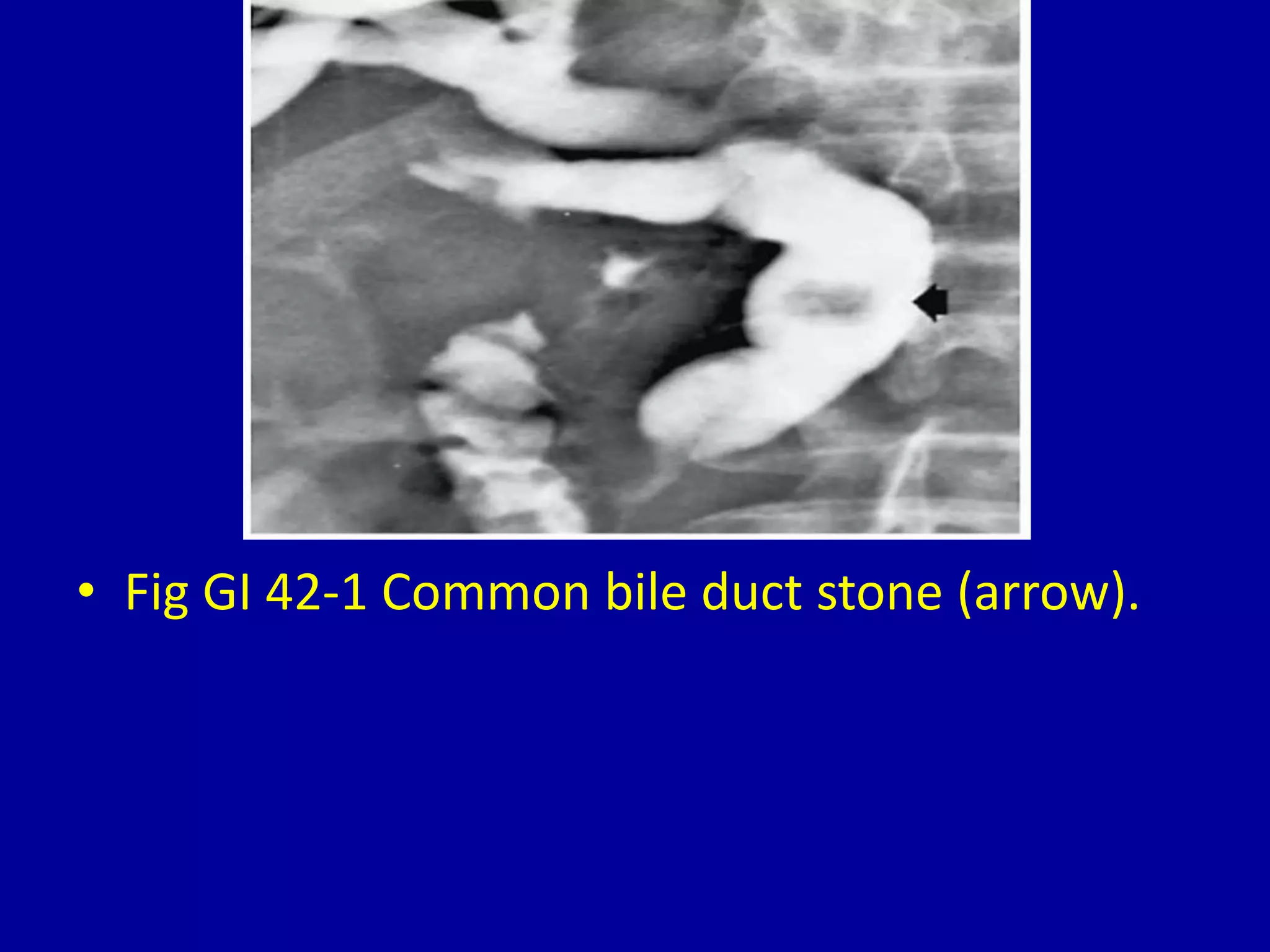 42 filling defects in the bile ducts | PPTX