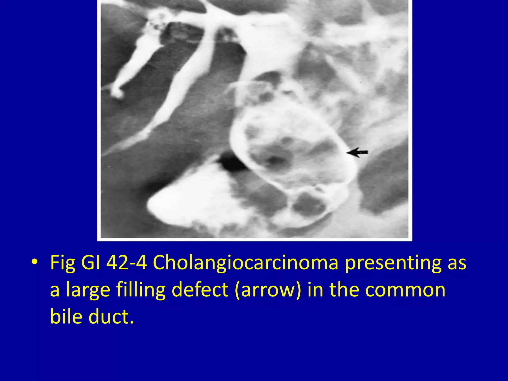 42 filling defects in the bile ducts | PPTX